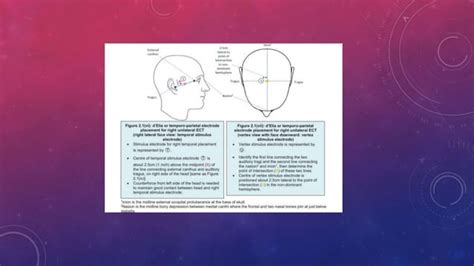 Ect Therapy And Guidelines For Trwatmentpptx Ppt