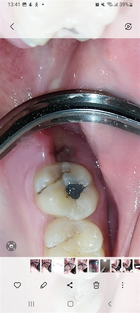 Day 4 Post Wisdom Teeth Removal Is This Looking Alright Rwisdomteeth