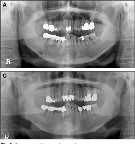 Figure 2 From Treatment Of Huge Mandibular Cyst With Enucleation After Decompression Under Local