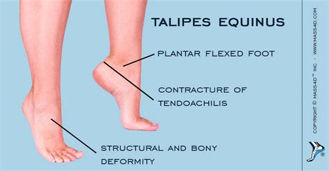 Filethe Equinus Footwebp Physiopedia