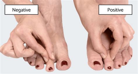Severe Leg Edema Icd 10