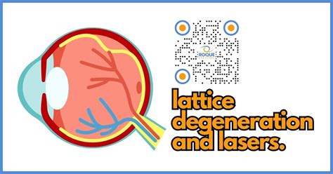 Understanding Lattice Degeneration Comprehensive Guide On Treatment