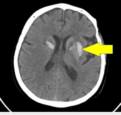 A Computed Tomography Scan Of The Head That Shows Acute To Subacute Download Scientific Diagram