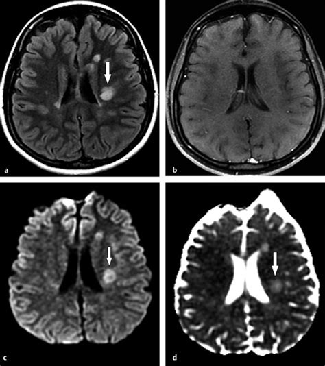 Diffusion Weighted Imaging And Diffusion Tensor Imaging In Demyelination And Toxic Diseases