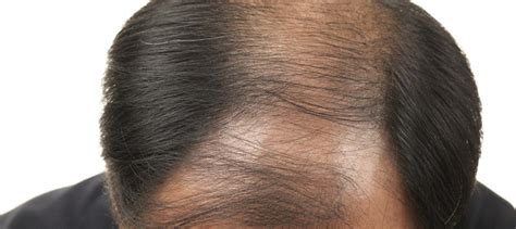 Scalp Conditions