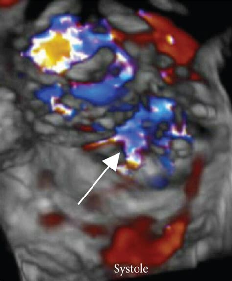 Leveraging Color M‐mode To Diagnose Aorto‐atrial Fistula As A