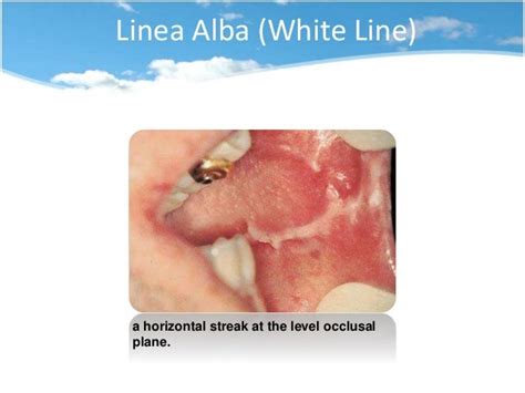Linea Alba Cheek Hurts Linea Alba And Oral Health What You Need To
