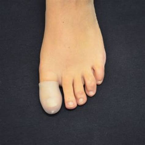 Crest Syndrome Toe