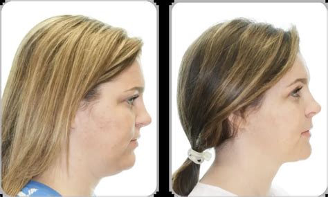 Maxillary Hypoplasia 7 Movahed Oms