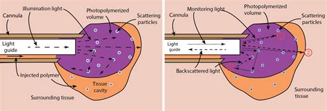 Miniature Probe For The Delivery And Monitoring Of A Photopolymerizable Material