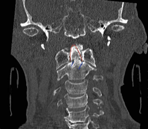 Odontoid Fracture Computed Tomography Jetem