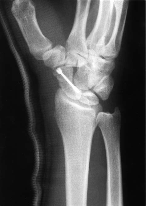 Scaphoid Fracture Screw Name At Jose Watson Blog