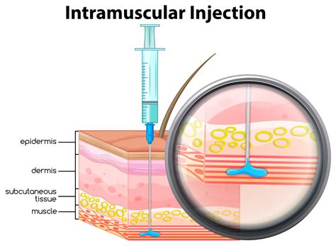 Intramuscular Injection Nhs Injection Intramusculaire Danger Wwfjoo
