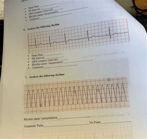 Solved Heart Ratepr Intervalqrs Complex Intervalrhythm