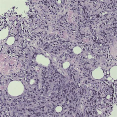 Enlarged Lymph Nodes In The Inguinal Area See Arrow Download