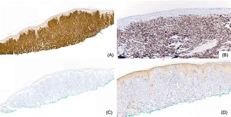 A Cd56− Immunoblastoid Variant Of Blastic Plasmacytoid Dendritic Cell