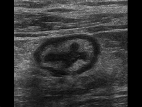 Abdomen And Retroperitoneum 16 Gastrointestinal Tract Case 164