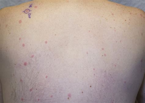 Mycoplasma Pneumoniae Induced Rash And Mucositis Mayo Clinic Proceedings