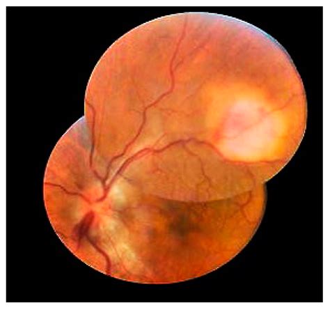 Human Immunodeficiency Virus And Uveitis
