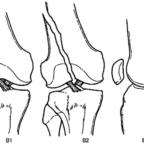 Lateral Radiograph Of B3 Fracture Of Femoral Condyle Download Scientific Diagram