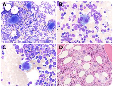 Mdsmpn U With Persistent Monocytosis Del20q And Calr Mutation The