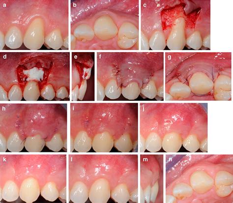 Clinical Procedures A Frontal View And B Occlusal View Of Left