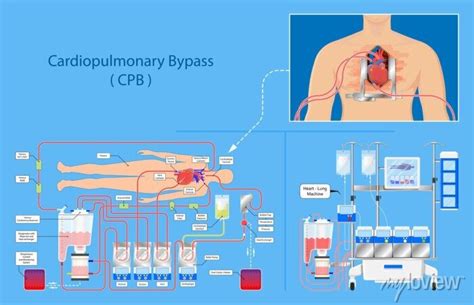 Cardiopulmonary Bypass Heart Lung Machine Coronary Oxygenator Posters