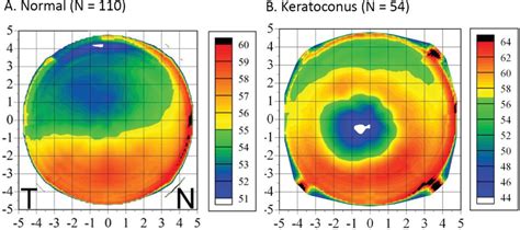 Epithelial Thickness Mapping For Keratoconus Screening By Vhf Digital Ultrasound Or Anterior