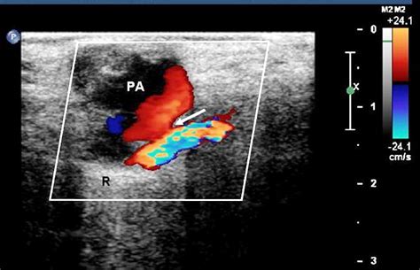Radial Artery Pseudoaneurysm In The Intensive Care Unit Annals Of