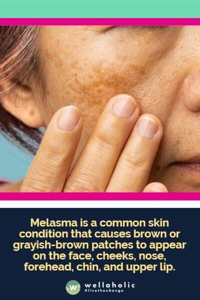 Melasma Meltdown Understanding And Managing This Common Skin Condition