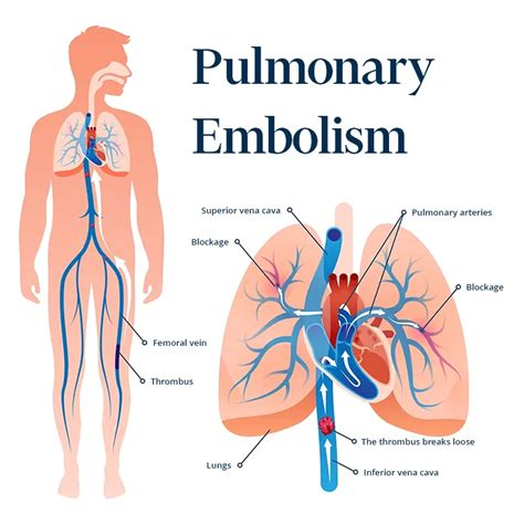 Pulmonary Embolism Venart Clinic