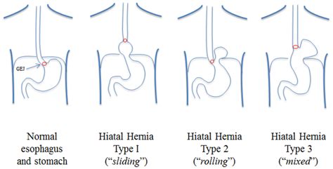 Classification Of Hiatal Hernias Paraesophageal Hernias Are Of Type