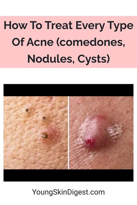 How To Treat Every Type Of Acne Comedones Nodules Cysts Types Of