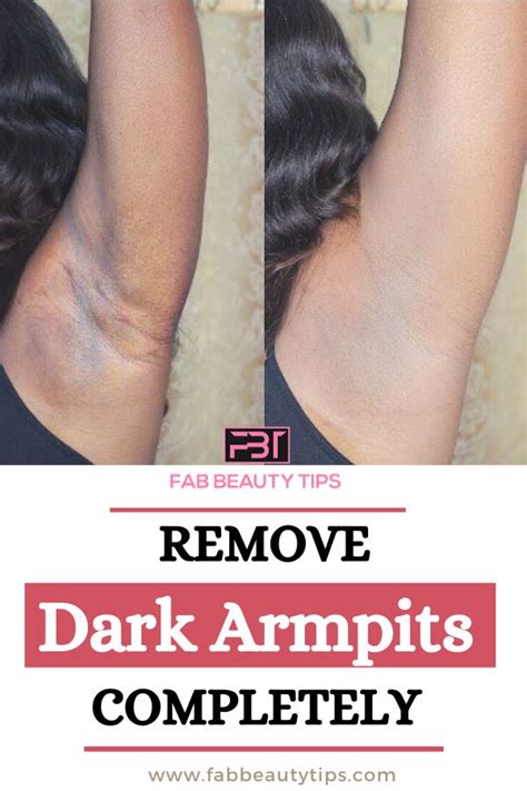 What Causes Black Spots On Armpits at Nicole Gibbs blog