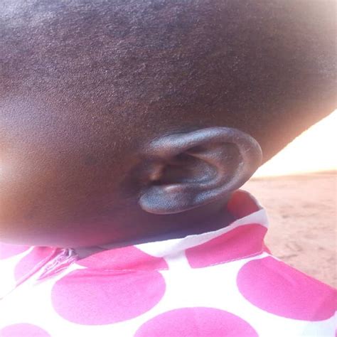 A Early View Of Pyoderma Gangrenosum B Established Lesion Of