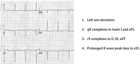 Lafb Ecg Axis