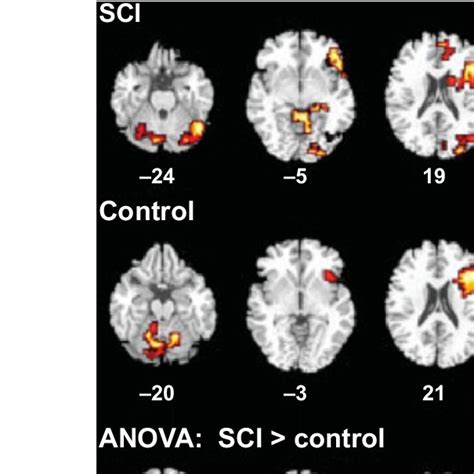 Group Activation Maps During Encoding In Subjective Cognitive Decline Download Scientific