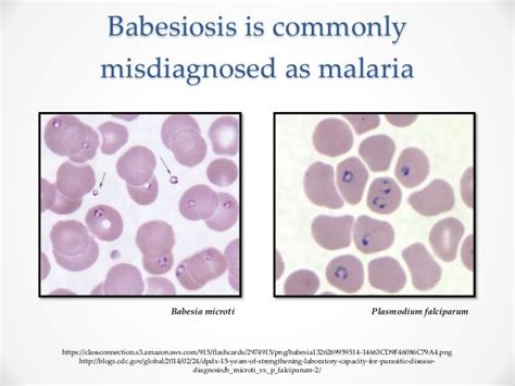 Babesiosis Final Prep