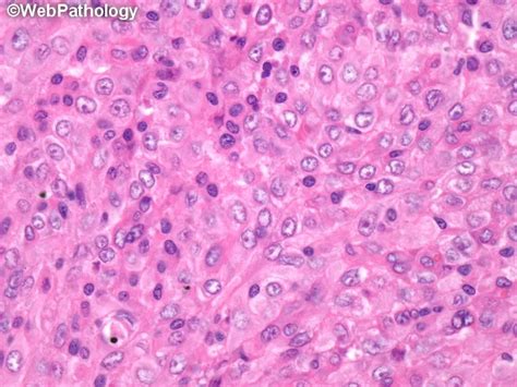 Type B3 Thymoma