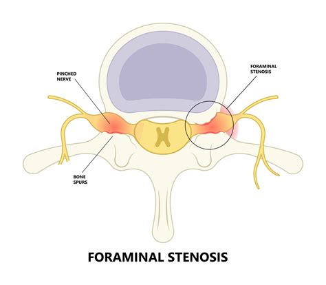 Top Remedies For Foraminal Stenosis Symptoms And Treatments