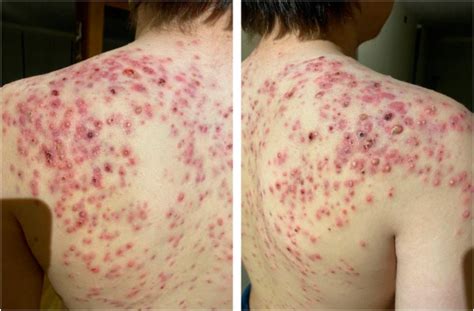 Severe Acneiform Eruption Associated With Tnfrsf13b Mutation Clinical Response To Adalimumab