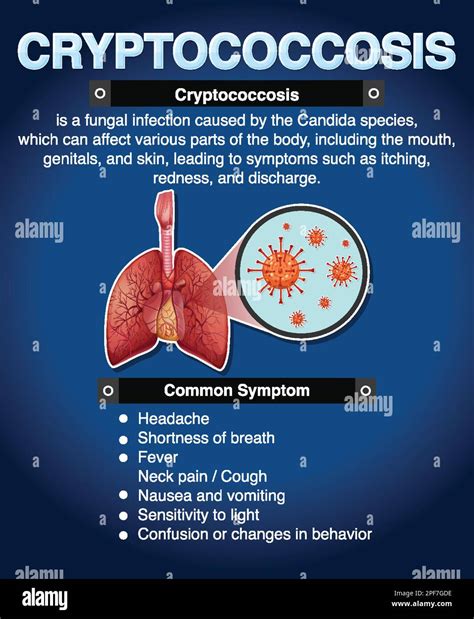 Informative Poster Of Cryptococcosis Illustration Stock Vector Image