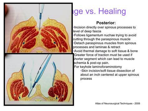 Laminectomy Vs Discectomy In Rehabilitation Ppt