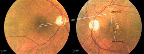 Fundus Exams Amd Soft Drusen And Geographic Atrophy