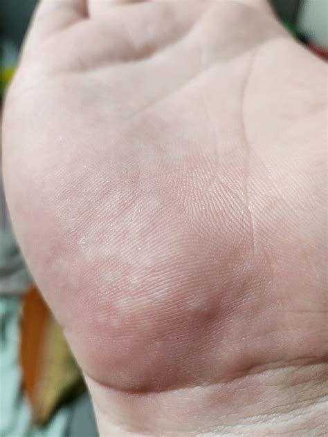 손바닥 간지러움 지식in