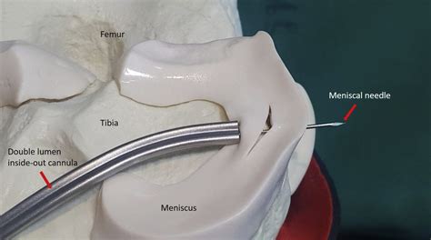 Meniscal Repair Surgery Hip Knee Shoulder Surgeon Newcastle Dr