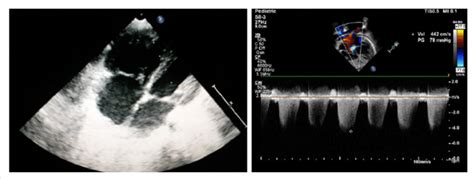Echo Pulmonary Hypertension Download Scientific Diagram