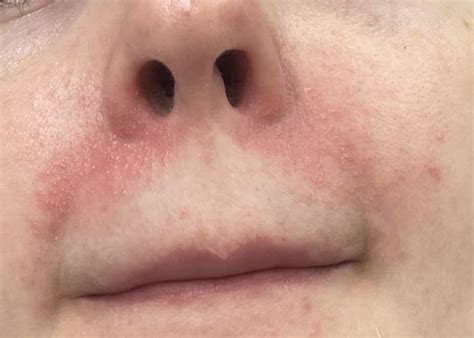Dermatitis Flare Up Rtretinoin