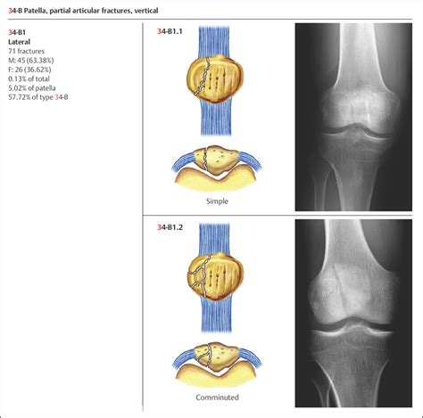 Fractures Of Other Locations Musculoskeletal Key