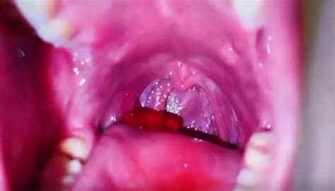 Gummy Swallow Video 15